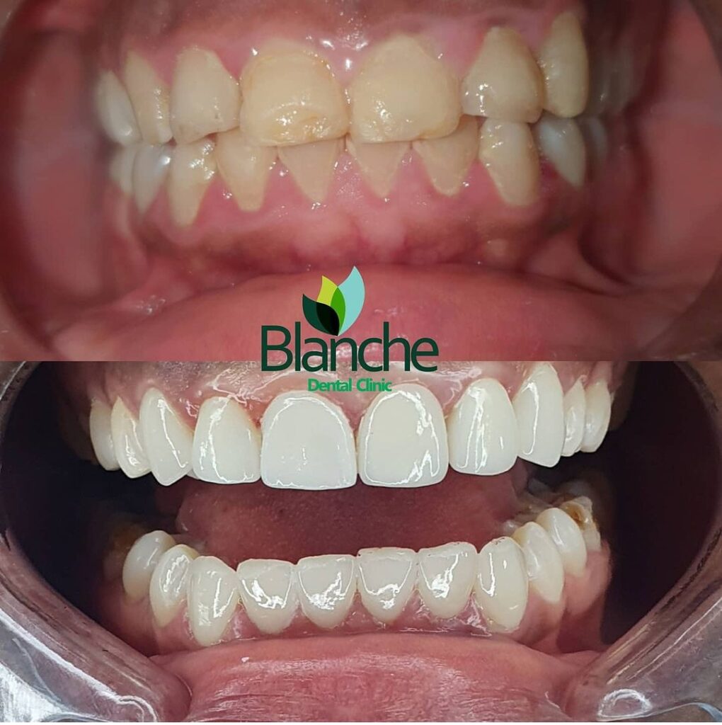 Get Whiter Teeth With Dental Veneers in Lagos | Abuja